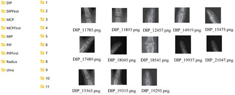 Symmetry Free Full Text Symmetry Based Fusion Algorithm For Bone