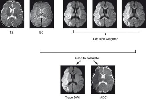 Diffusion Weighted Magnetic Resonance Imaging Principles And Implementation In Clinical And