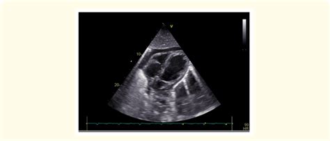Pericardial Effusion Subxiphoid Section Download Scientific Diagram