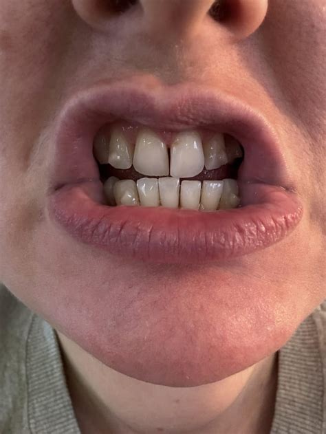 Ipr Worry R Invisalign