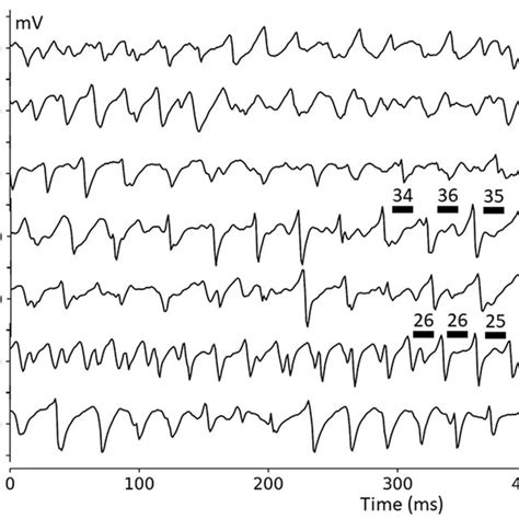 Unexpected Atrial Fibrillation At The Right Atrium A Positioning Of Download Scientific