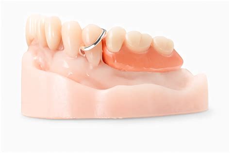 Dental Code D5214 Partial Denture With Precision Attachments Lema