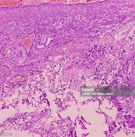연조직 사구체 종양 또는 부신경절종 현미경으로 연조직 Glomus 종양의 특징 양성이지만 국소 침습성 종양을 보여줍니다 건강 진단에 대한 스톡 사진 및 기타 이미지 Istock