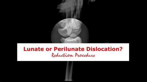 Perilunate And Lunate Dislocation Types