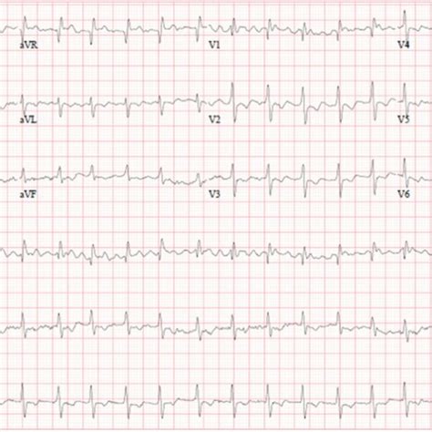 Ecg On Admission Shows Atrial Flutter With Variable Block Download Scientific Diagram