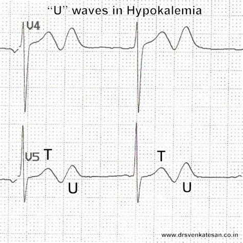 Electrocardiographic Tracings With Hypokalemia And