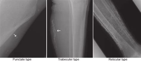Radiographic Features Of Subcutaneous Calcification Download