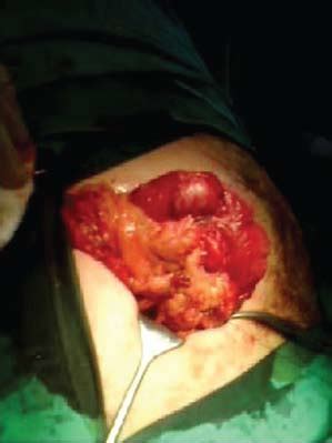 Large Perforation Of The Appendix At The Base Of The Caecum Figure Download Scientific