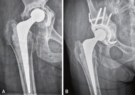 A Review And Description Of Acetabular Impaction Bone Grafting