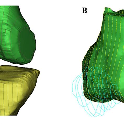 Segmentation Of Bone In Sagittal Plane A Segmentation Of Femur And