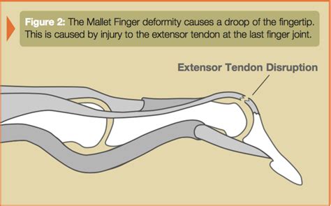 Mallet Finger Extensor Tendon Repair At Erin Patteson Blog