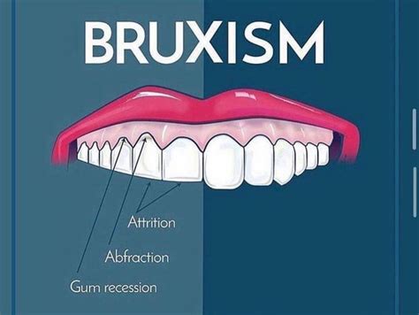 Bruxism Medizzy