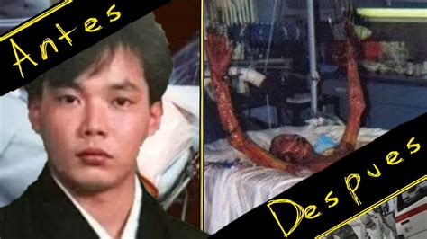 Hisashi Ouchi Rare Hospital Photos Reveal Effects Of Extreme