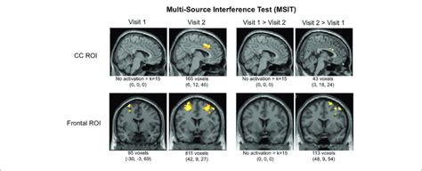 Functional Magnetic Resonance Imaging Fmri Activation In Cingulate