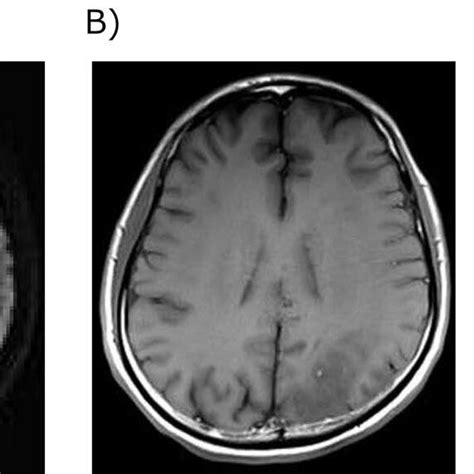 Magnetic Resonance Imaging Of The Brain Infarction A Download Scientific Diagram