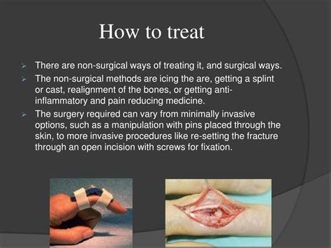 PPT Dislocated Pip Joint PowerPoint Presentation Free Download ID 2017245