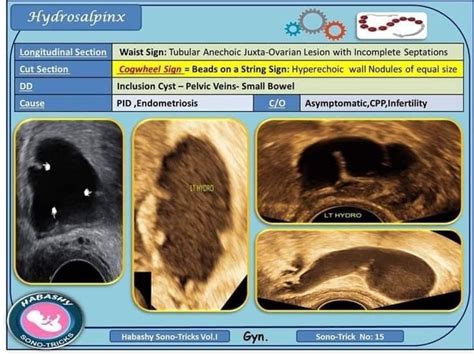 Radiology The Image Is An Educational Summary About Hydrosalpinx On