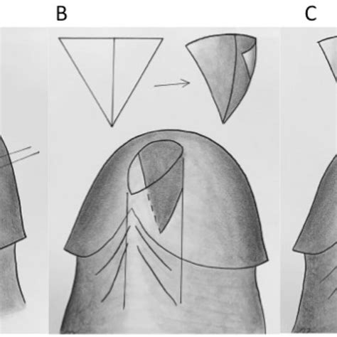 A Representative Example Of A Patient With A Fossa Navicularis