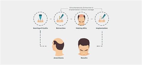 Female Hair Transplant Solutions Folliderm