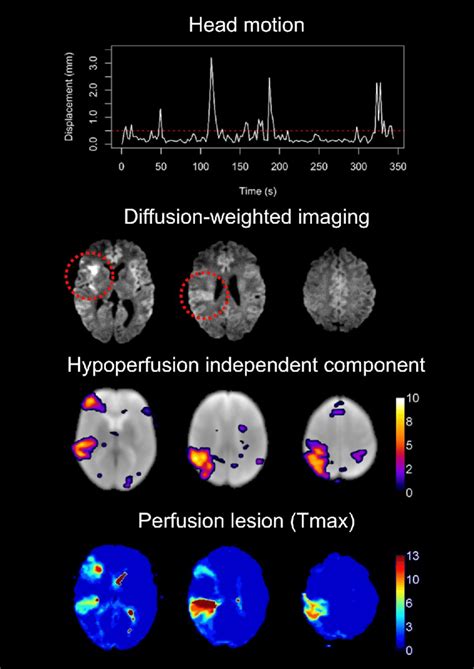 Hypoperfusion Independent Components Hics Are Detected Using