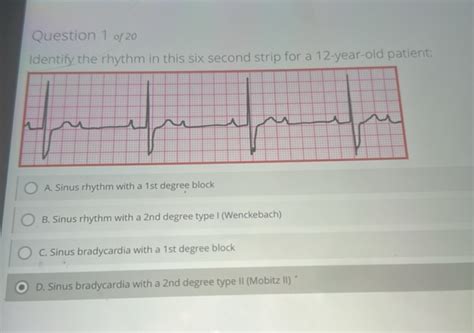 Identify The Rhythm In This Six Second Strip For A 12 Year Old Patient