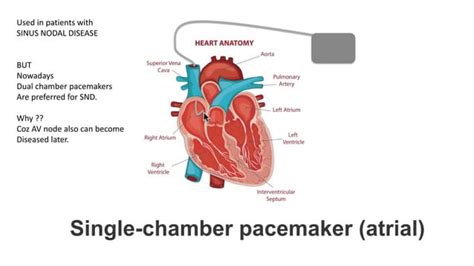 Basics Of Pacemaker Dr Hafeesh Fazulu Pushpagiri Pptx Heart And