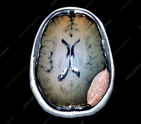 Brain Cancer Mri Stock Image C0239826 Science Photo Library