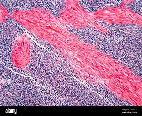 Sarcoma Light Micrograph Of A Section Through A Sarcoma Pink Sarcomas Are Malignant