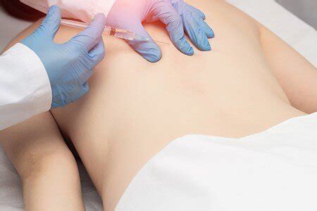 Trigger Injections Knotry