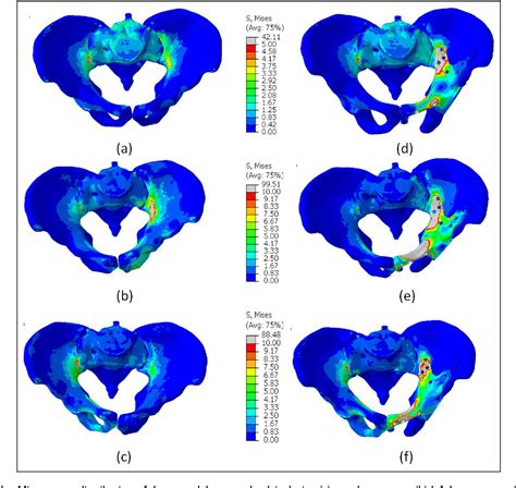 Figure 7 From Development Of Finite Element Model For Customized Prostheses Design For Patient