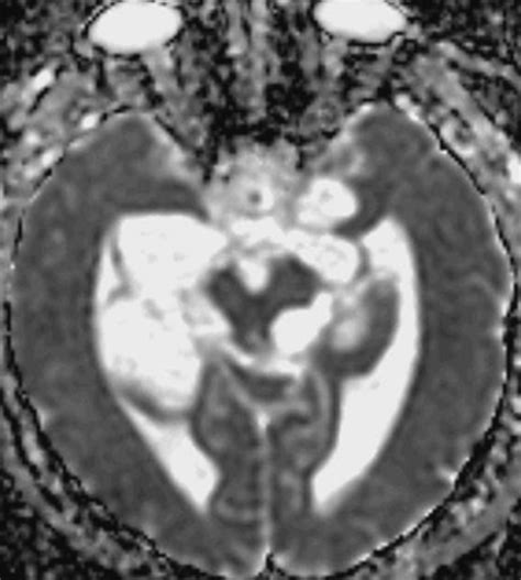 November 20 2014 Case Of The Week American Journal Of Neuroradiology