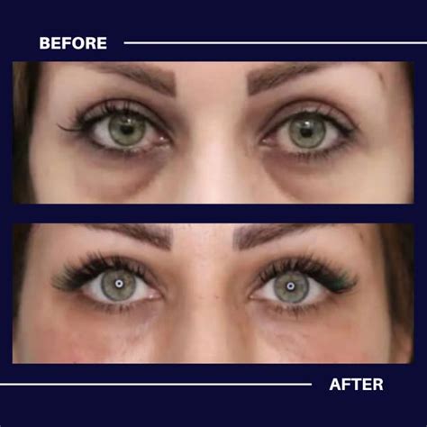 Filler Injection In Under Eyes Nora Health Tour