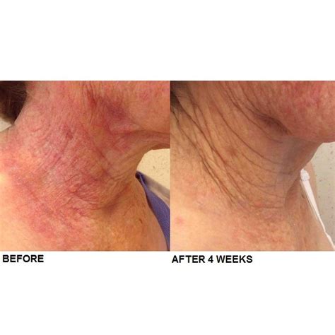 Best Images About Serious Skin Care Before And After On Pinterest Eye Gel Sagging Skin