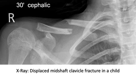 Clavicle Xray Angle