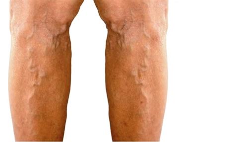 Разширени вени признаци симптоми и рискови фактори Терминът разширени вени или варикоза на