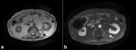 Mri Of The Abdomen And Pelvis A Axial T2 B Fat Suppression Axial T1