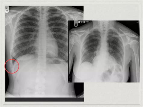 Chest Wall Tumor Pdf