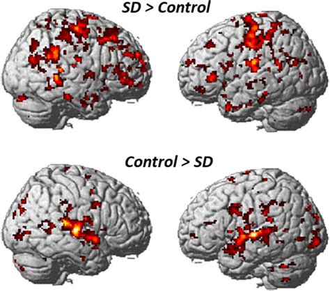 Hyperactive Sensorimotor Cortex During Voice Perception In Spasmodic Dysphonia Abstract