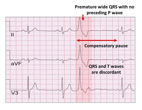 Ventricular Interpolation And All That Jazz