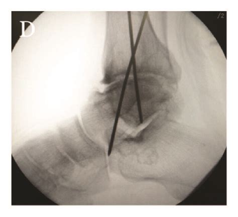 Ankle Arthrodesis Assisted By 3d Printed Personalized Guide A B