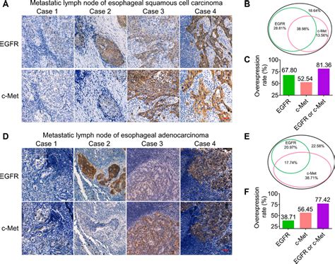 Complementary Expression Of Egfr And C Met In Mlns Of Escc And Eac A Download Scientific
