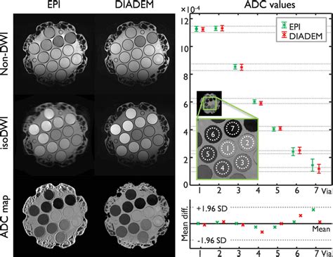 Distortion Free Imaging A Double Encoding Method Diadem Combined With Multi Band Imaging For