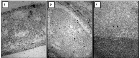Case 2 A Electron Microscopy Assay Of Fat Pad Biopsy Amyloid