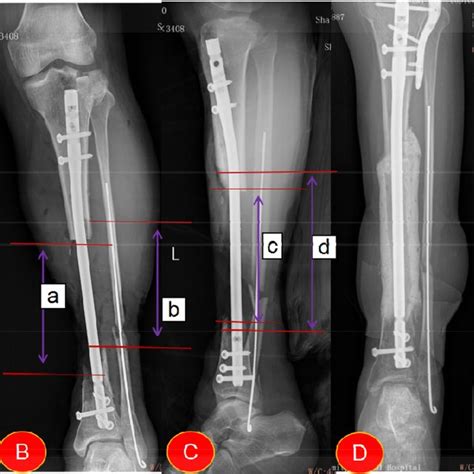 Pdf Masquelet Technique For Reconstructing Bone Defects In Open Lower Limb Fracture Analysis