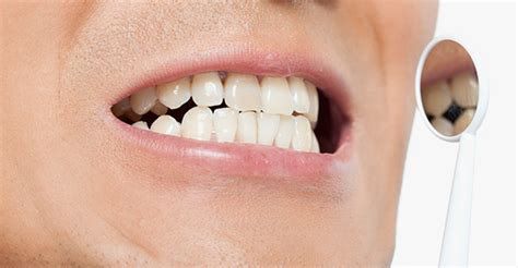 자가치아뼈이식 바른탑치과 의왕점