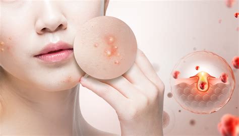 여드름 엘로디의원