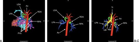 Cardiac Computerized Tomographic Angiogram With Three Dimensional