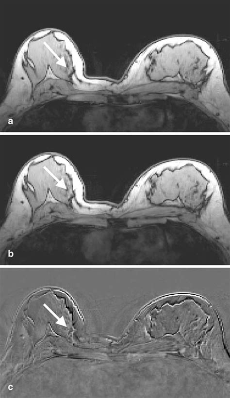 2d Multislice Rf Spoiled Gradient Echo Sequence Tr Te α 360 Ms 7 Download Scientific