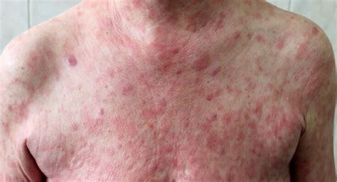 Cutaneous T Cell Lymphoma Symptoms And Causes