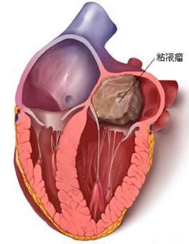 心脏内粘液瘤 搜狗百科